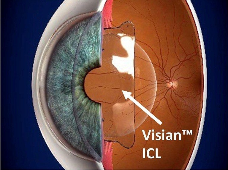 Phakic Implantable Collamer Lens (ICL) - CarlinVision
