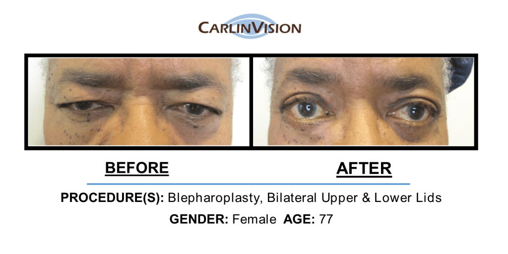 Eyelid Surgery - CarlinVision