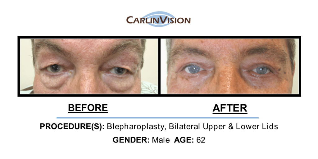Eyelid Surgery - CarlinVision
